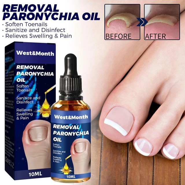 GERMAN TOENAILCARE OIL For Removing Paronychia, Ingrowing Treatment ...