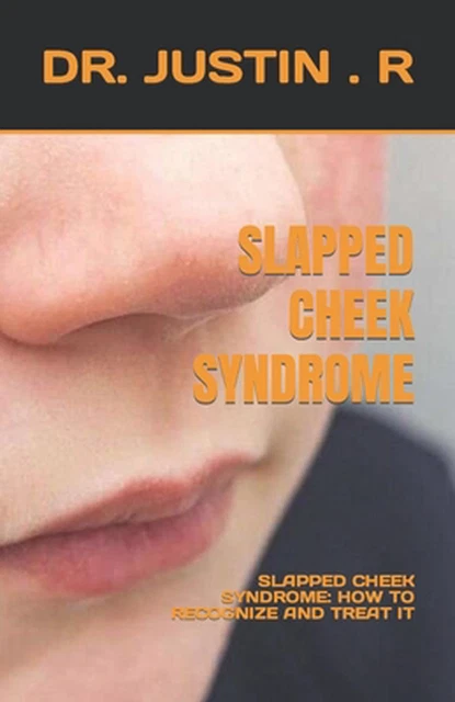 SLAPPED CHEEK SYNDROME: Slapped Cheek Syndrome: How to Recognize and ...