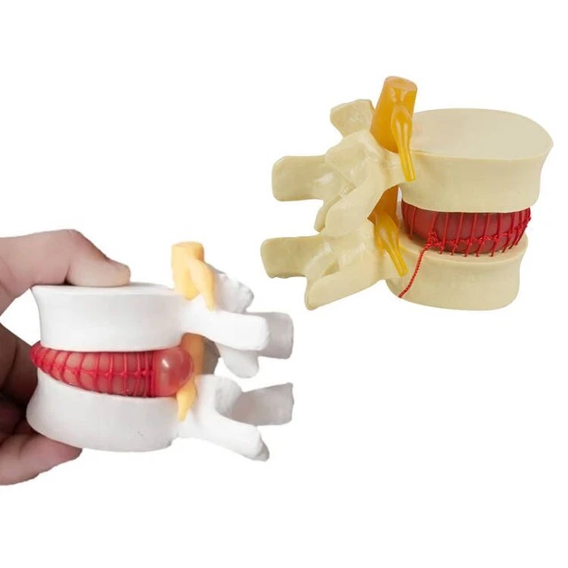 HUMAN LUMBAR DISC Herniation Demonstration of Lumbar Vertebral Spine ...