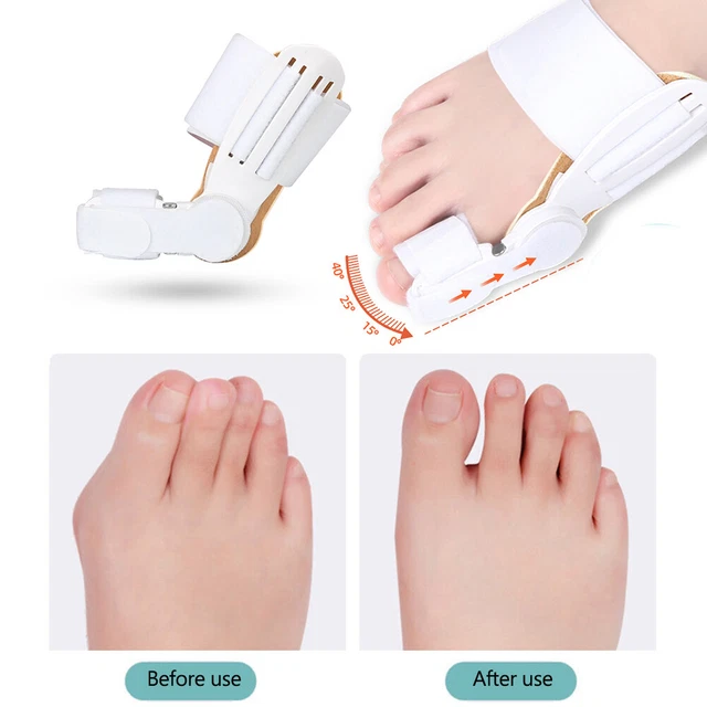 UNISEX FOOT HALLUX Valgus Braces Adjustable Hallux Valgus Orthosis for ...