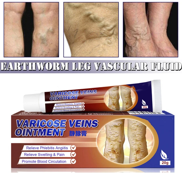 VARICOSE VEINS OINTMENT Improves Blood Circulation Heavy Legs Relief B ...