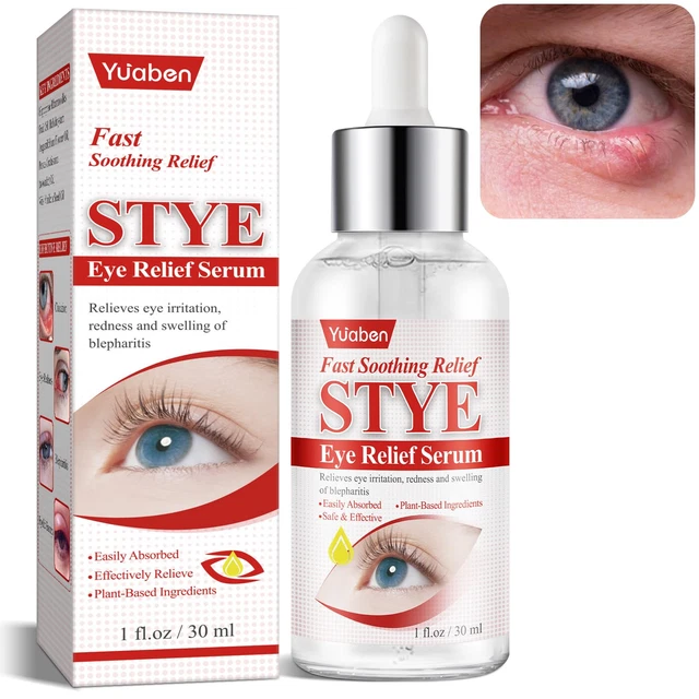 STYE EYE TREATMENT Drops, Eye Stye Remover for Chalazion, Blepharitis ...
