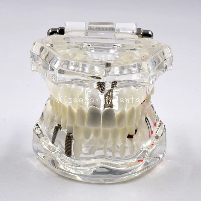 DENTAL STUDY TEACH Implant Teeth Model Restoration Bridge Caries ...