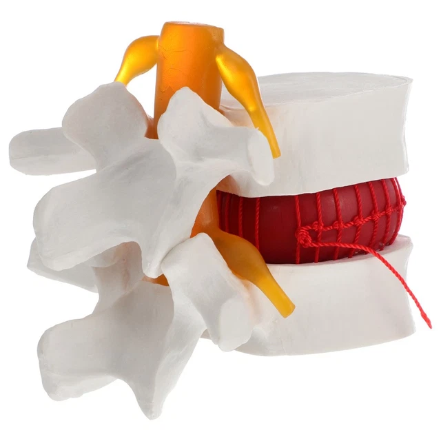 SPINE MODEL VERTEBRAL Column Lumbar Disc Herniation Presentation £14.49 ...