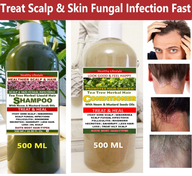 TREATMENT TINEA CAPITIS, Folliculitis Hair-Loss - Tea Tree Shampoo ...