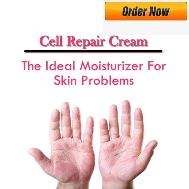SKIN MOISTURISER CREAM - Itchy Skin Rash Eczema, Psoriasis Dry skin ...