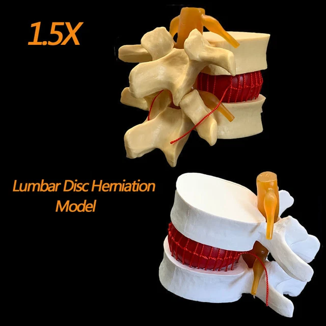1.5X ANATOMICAL SPINE Lumbar Disc Herniation Anatomy Medical Teaching ...