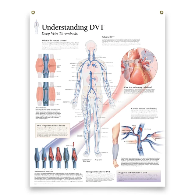 UNDERSTANDING DVT DEEP Vein Thrombosis Laminated Medical Poster Diagram ...