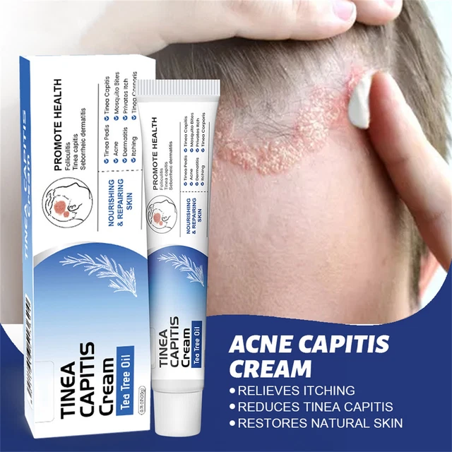 TEA OIL TINEA Ointment Seborrheic Dermatitis Head Skin Acne Tinea ...