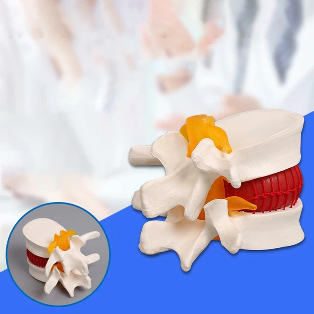 HUMAN LUMBAR DISC Herniation Model Lumbar Spine Model Anatomy Tool ...