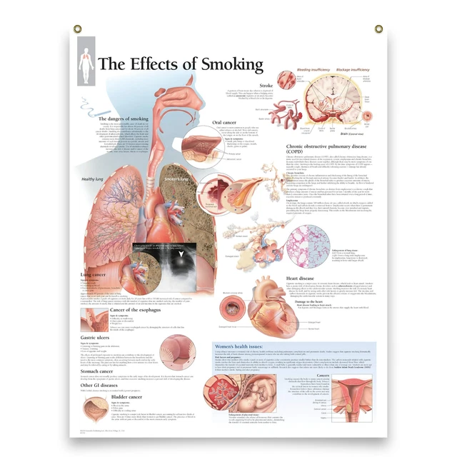 THE EFFECTS OF Smoking Laminated Medical Poster Diagram Doctors Office ...