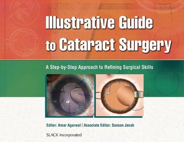 ILLUSTRATIVE GUIDE TO Cataract Surgery: A Step-by-Step Approach to ...