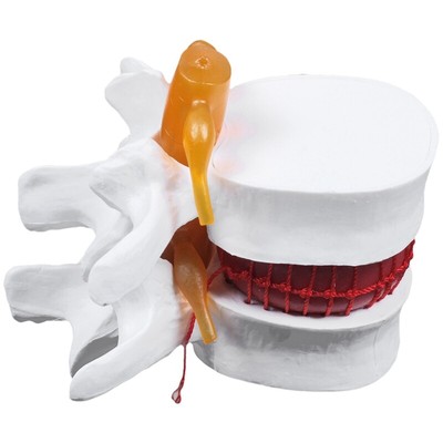 HUMAN ANATOMY SKELETON Spinal Column slipped disc teaching MP1 £17.42 ...