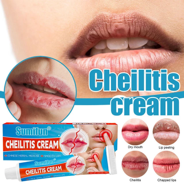 LIPS CARE CHEILITIS Cream Treatment Herpes Antibacterials Ointment Chapped Lips_ £6.78 - PicClick UK