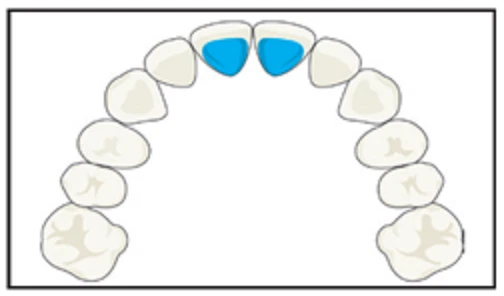 COMPOSITE RADIOPAQUE DTECH Dental COMPOMAX BLEU LC 4 g pour MORSURE EUR ...