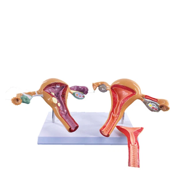PATHOLOGICAL AND NORMAL Uterus Ovary Model Anatomical Anatomy Disease ...
