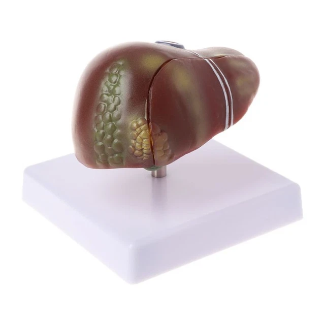 HUMAN LIVER PATHOLOGICAL Anatomical Model Anatomy School Medical ...