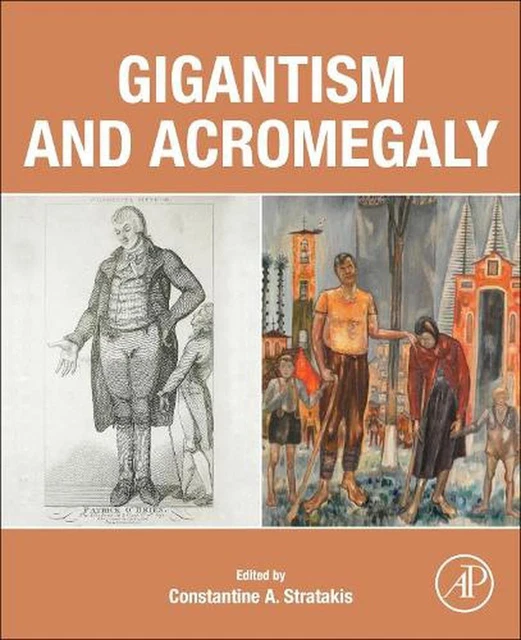GIGANTISM AND ACROMEGALY: Genetics, Diagnosis, and Treatment by ...