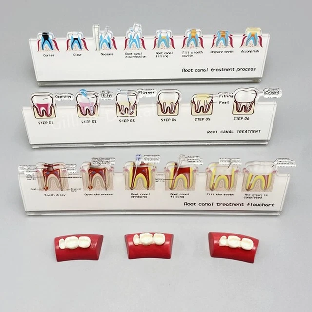 1 KIT DENTAL Pathological Model Root Canal Treatment/Process/Flowchart ...