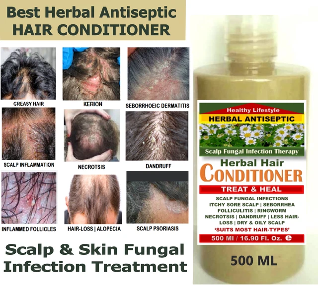 CURE SCALP RINGWORM Tinea Capitis - ANTISEPTIC HERBAL CONDITIONER 500 ...