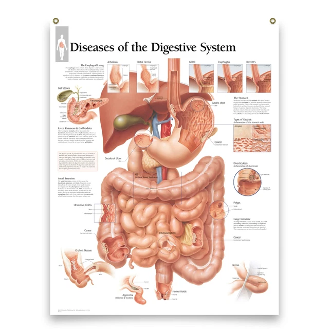 DISEASES OF THE Digestive System Laminated Medical Poster Diagram ...