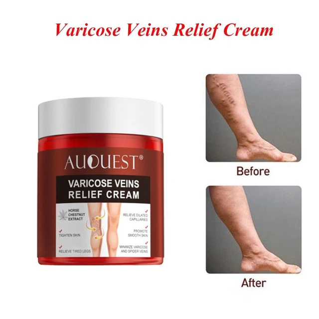 FADING CREAM HERBAL Ointment Legs Varicose Veins Cream Vasculitis ...