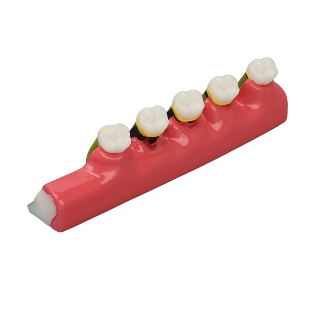 TEETH PERIODONTAL DISEASE Model Different Stages Resin Dental ...