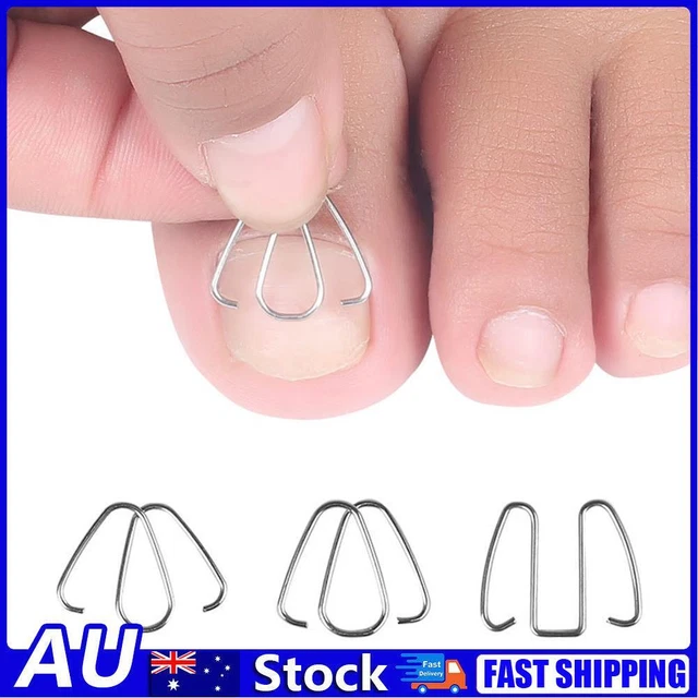INGROWN TOE NAIL Correction Hook/Rubber Band Paronychia Orthosis ...