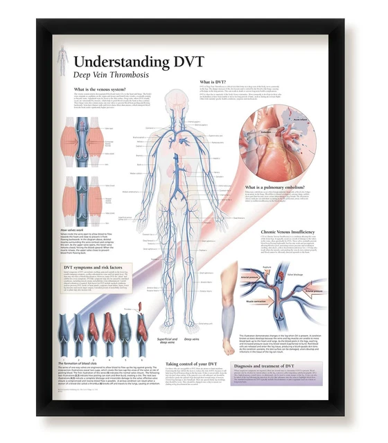 UNDERSTANDING DVT DEEP Vein Thrombosis Medical Poster Diagram Doctors ...