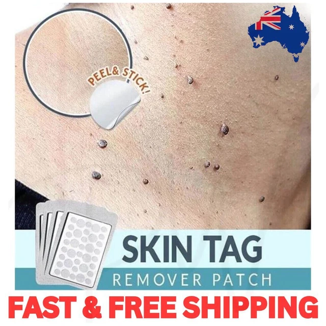 SKIN TAG REMOVER Acne Pimple Patch Removal Facial Care Spot Plaster ...