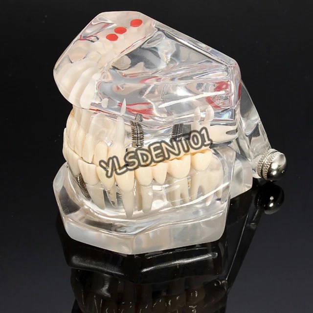 DENTAL TEETH MODEL Teach Study Oral Implant Restoration & Pathology ...