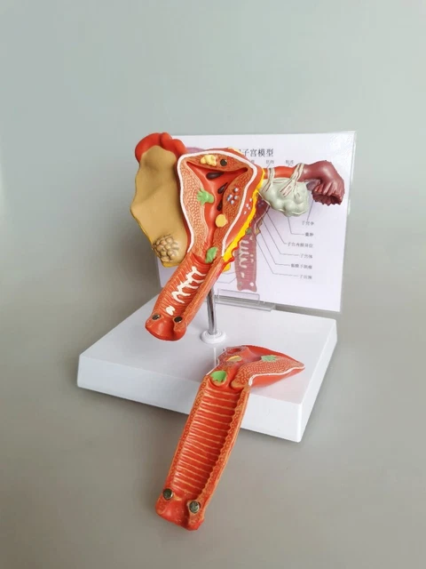 PATHOLOGICAL MODEL OF Female Reproductive System, Genitourinary Medical ...