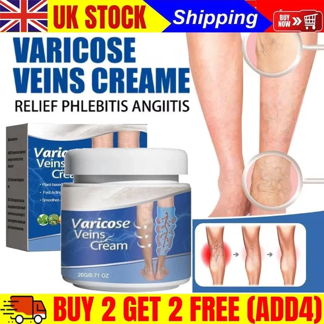 VARICOSE VEINS TREATMENT Cream Vasculitis Phlebitis Spider Relief Pain ...