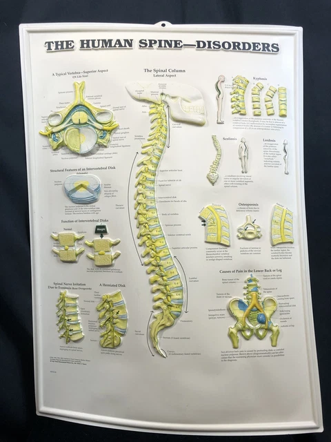 VINTAGE ANATOMICAL “THE Human Spine Disorders” Chart 3D ~ Rare £29.99 ...