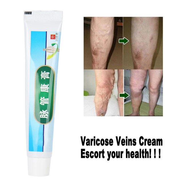 PHLEBITIS VARICOSE VEINS Collapse Kang Diabetic Foot Vasculitis Leg ...