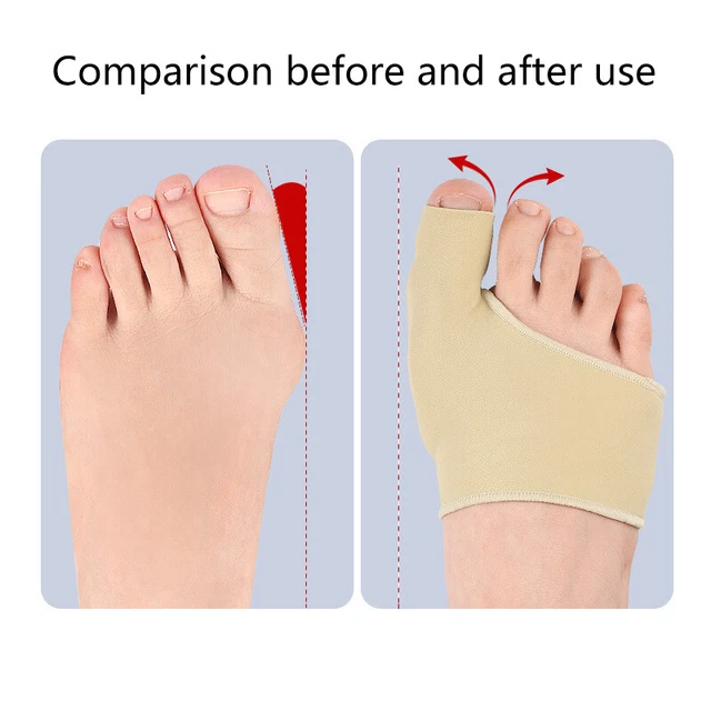 BUNION CORRECTOR HAMMER Toe Splint Straightener Orthopedic Brace Valgus ...