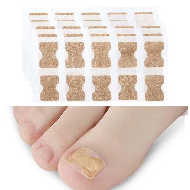 PACK 50 INGROWN Toenail Corrector Paronychia Treatment Toenail Patch ...