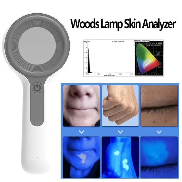 UV WOODS LAMP Examination Dermatology Skin Anyalyzer For Vitiligo CE ...