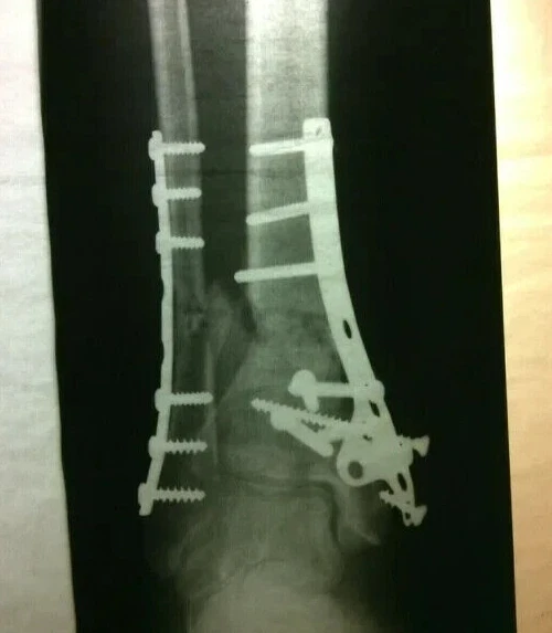 HOSPITAL MEDICAL X-RAYS Human Anatomy Leg Ankle Plate Fracture Tibia ...