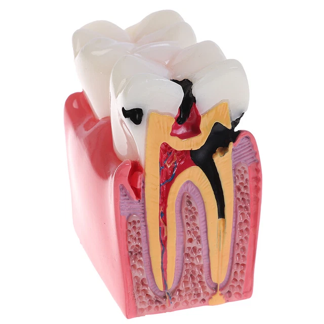 DENTAL TEETH MODEL 6 Times Caries Comparation Study Denture Tooth Mod ...