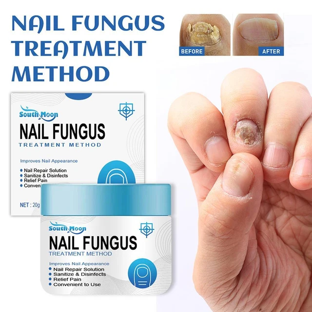 NAIL FUNGUS FUNGAL Removal Cream Treatment Care Onychomycosis GX Toe ...