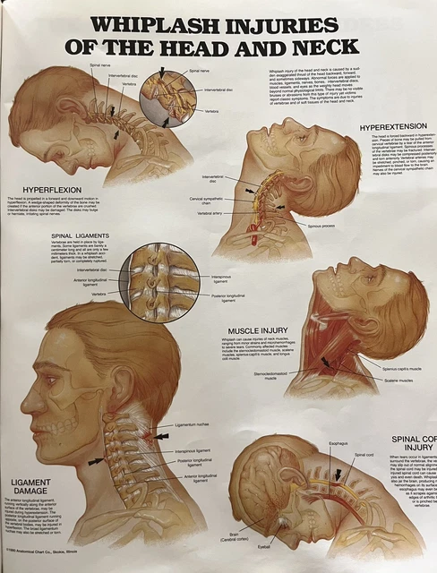 THE ANATOMICAL CHART ~ Whiplash Injuries of the Head and Neck ~ 11.25 x ...