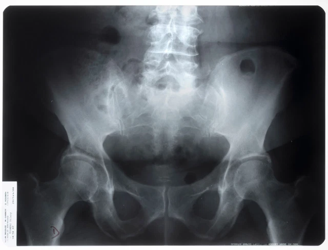 GENUINE VINTAGE HOSPITAL X-Ray Human Pelvis, Hip Socket Original ...