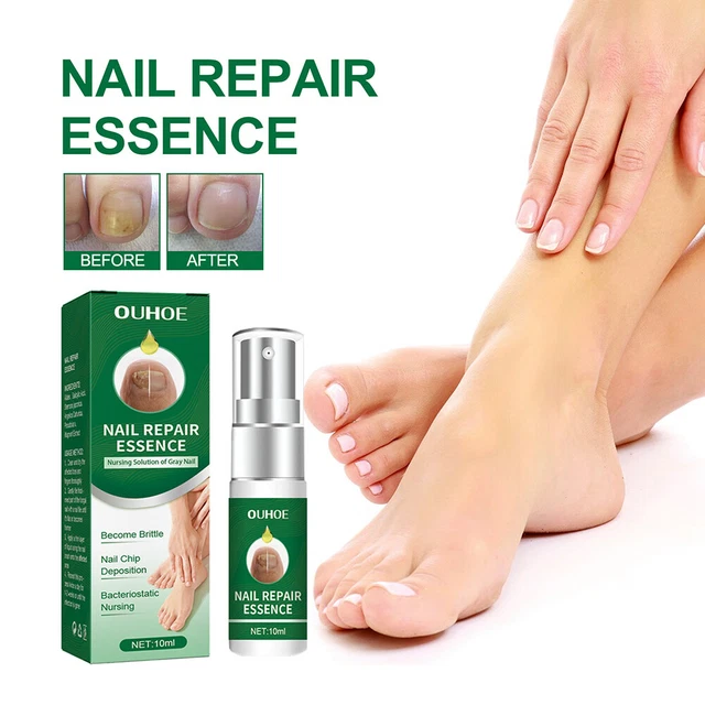 NEW FOOT FUNGAL Removal Repair Gel Anti-infective Paronychia ...
