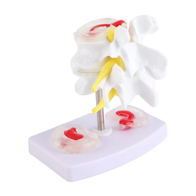 ANATOMICAL LUMBAR DISC Herniation Demonstration Model Human Spine ...