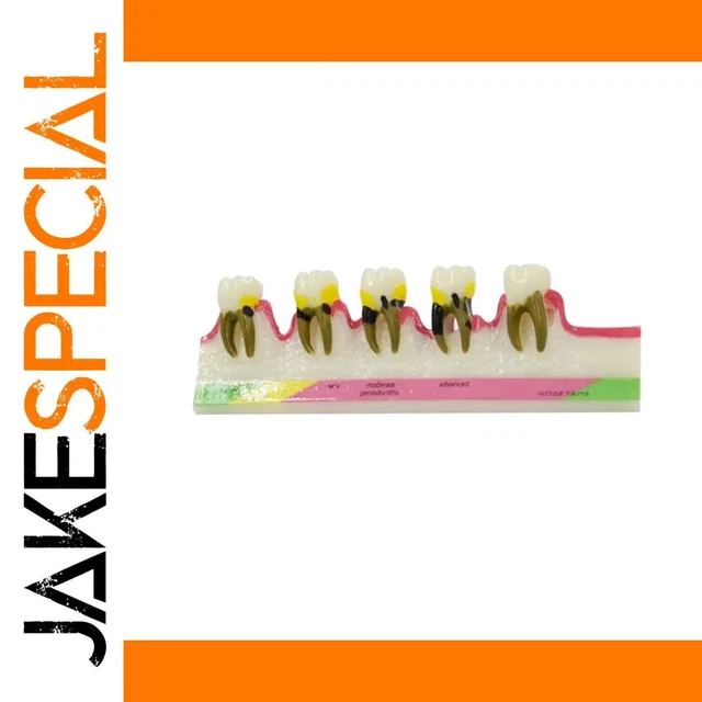 JAKESPECIAL – REALISTIC Periodontal Disease Model for Dental Education ...