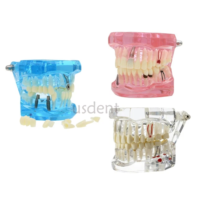 DENTAL M2001 IMPLANT Teeth Model Bridge Restoration Pathology Teach ...
