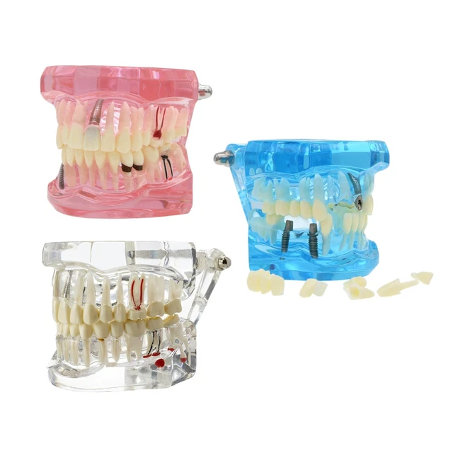 DENTAL IMPLANT TEETH Model Bridge Restoration Pathology Teach Study ...
