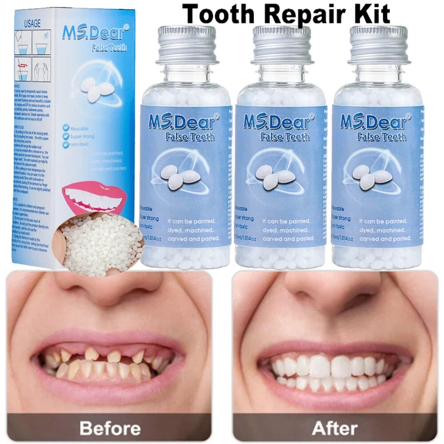 3~STRONG TOOTH REPAIR Granules Temporary Tooth Repair Kit Fitting Beads ... 3~STRONG TOOTH REPAIR Granules Temporary Tooth Repair Kit Fitting Beads ...
