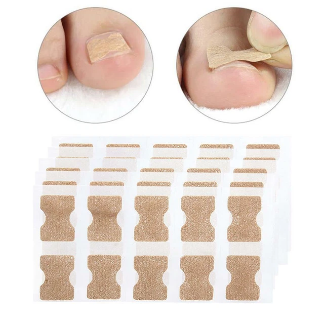 50PC PARONYCHIA TOENAIL Treatment Tape Correcto Ingrown Toenail Tape ...